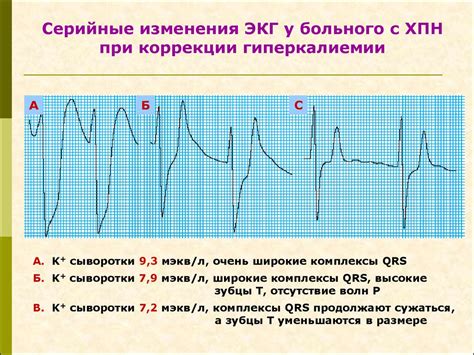 Гиперкалиемия Эпидемиология и симптомы презентация онлайн