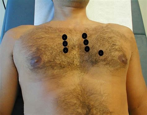 The Brugada Syndrome Ecg Vcg Diagnosis Cardiolatina