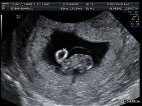 Ultrasonido De 2 Meses De Embarazo Imagui