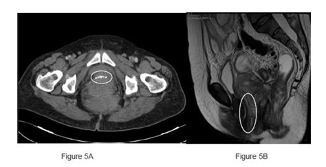 Axial Ct Image Documenting Splenic Abscesses J O U R N A L P R E P R