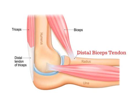 Distal Biceps Tendon Tear Orthopedic Elbow Specialist Manhattan New York City Westchester