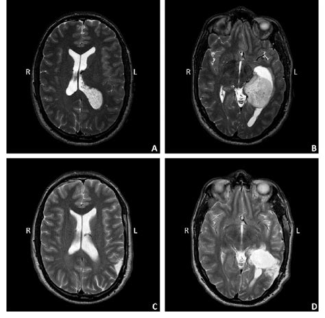Case 4 Preoperative Axial T2 Weighted Mr Of The Brain Demonstrating A