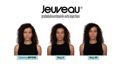 Jeuveau® Botulinum Toxin Type A Hilton Head Plastic Surgery And Medspa