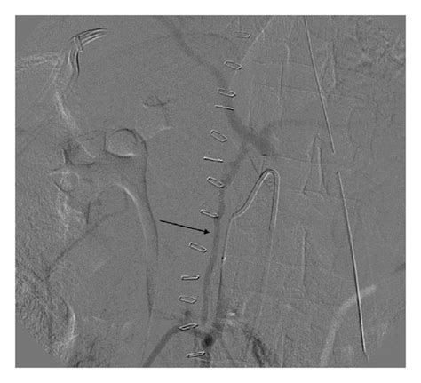 Selective Angiography Of Superior Mesenteric Artery Demonstrating The Download Scientific