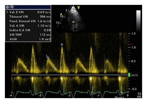 Diastolic Dysfunction In A Cirrhotic Patient Diagnosed During Download Scientific Diagram