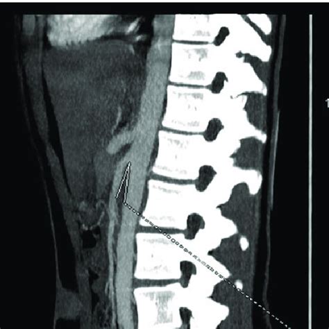 Abdominal Ct Scan Axial Cut Revealing A Shortened Distance 4 Mm