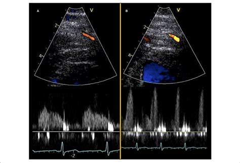 Transthoracic Doppler Echocardiography And Pulsed Wave Doppler Download Scientific Diagram