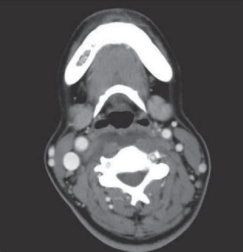 Pitfalls Of Ct For Deep Neck Abscess Imaging Assessment A