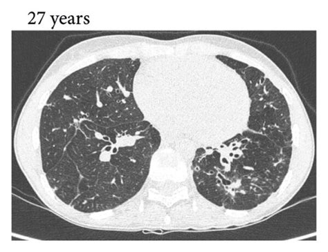 Chest Computed Tomography Scan At Age 22 Years As Well As Multiple