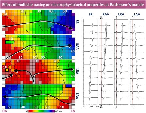 Po 02 184 Mapping Guided Atrial Lead Placement Determines Optimal