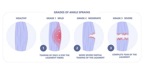 Ankle Sprain Physiotherapy Propel Physiotherapy