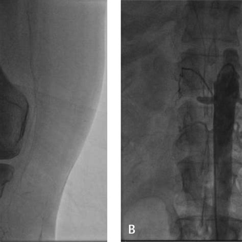 Normal Diameter Of Abdominal Aorta With Age N 1218 Mean±standard