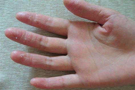 进行性掌跖角化病手指脱皮图片