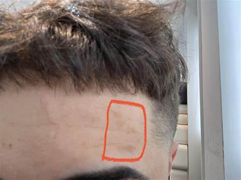 What Are These Dark Spots On My Forehead Rskin