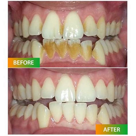 Dental Problem Treatment In Delhi Ncr India Indiadens