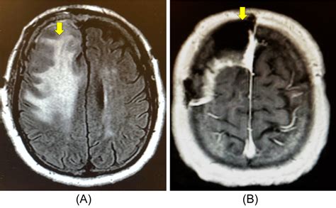 Solitary Brain Metastasis In Low Risk Prostate Cancer A Case Report