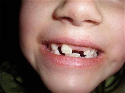 Запечатват зъбите на децата срещу кариес