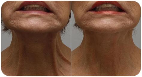 Botox® For Neck Bands Treatment In Torrance Ca Lumier Medical