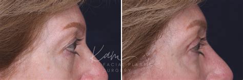 Laser Or Traditional Blepharoplasty New Jersey