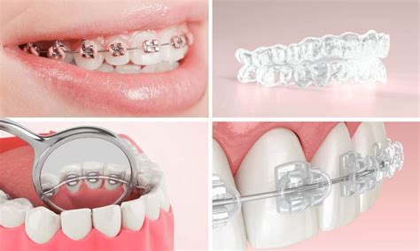 Affordable Braces Cost And Types In South Africa 2026