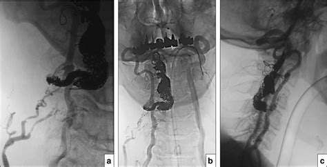 Final Angiogram A Right Subclavian Angiogram Arteriovenous Shunts