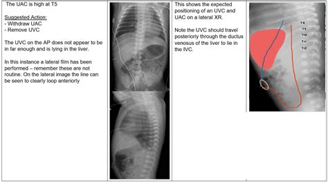 Umbilical Catheters Nhsggc