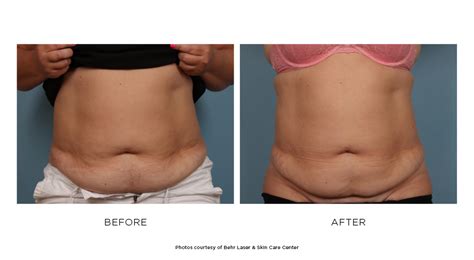 Coolsculpting® Elite Before And After Photos Behr Laser And Skin Care Center