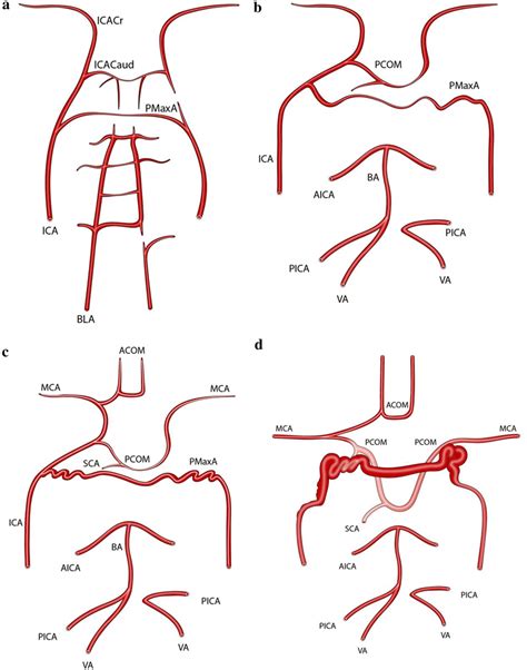 Schematic Illustration Of The Patients Embryological Stages Of
