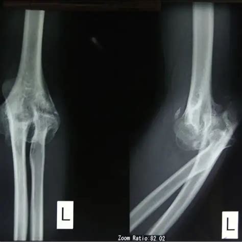 X Ray Left Elbow Joint Ap And Lateral View Test Price In Delhi Ganesh