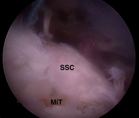 Completed Reconstruction Of Subscapularis Tendon Ssc A Right