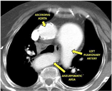 Aneurysmatic Retroesophageal Aberrant Right Subclavian Artery Arsa