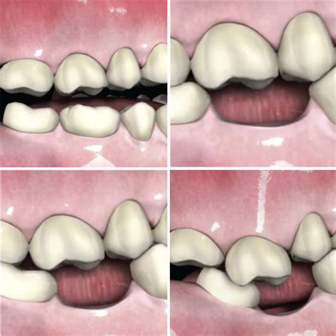 What Is An Dental Implants Essex Dental Centre