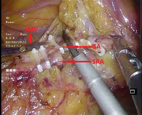 A novel technique for NO.253 lymph node dissection and left colic artery preservation to avoid ...
