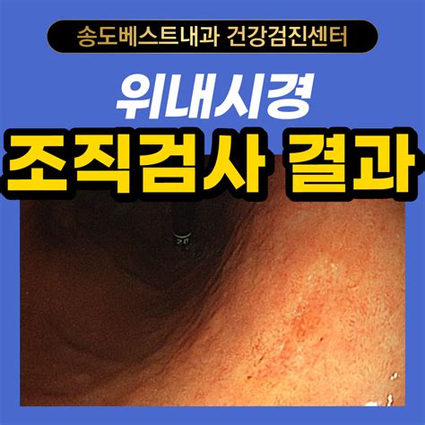 위내시경 조직검사 결과 위염 위궤양 위암 네이버 블로그