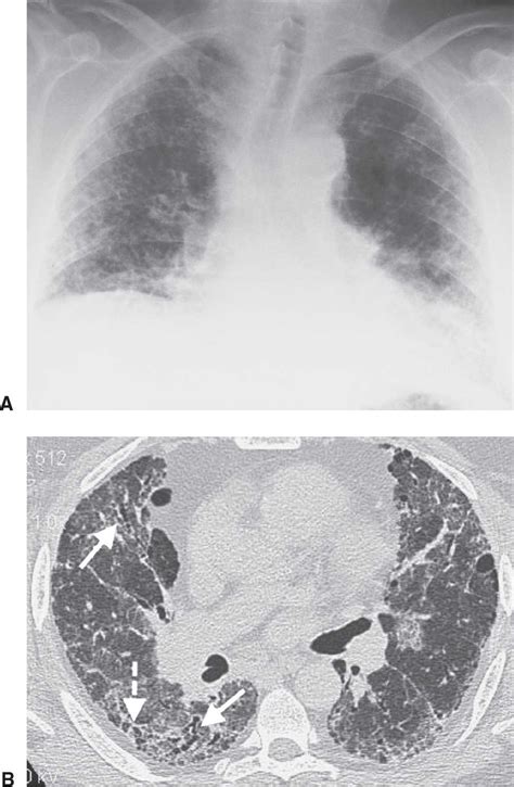 Interstitial Lung Disease Radiology Key