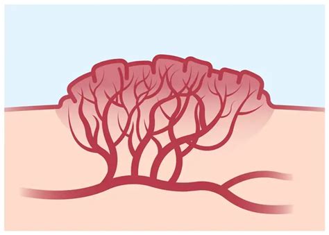 Vascular Malformation Treatment
