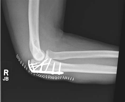 Olecranon Orif R Radiology