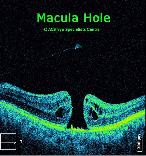 Acs Eye Specialists Oct Optical Coherence Tomography Used For