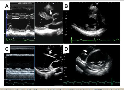 Figure 1 From Untreated Cardiac Sarcoidosis With Active Inflammation