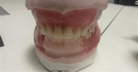 Rpd Denturedentistry Album On Imgur