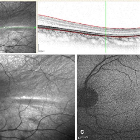 Sd Oct Imaging Of The Left Eye Of Patient No 1 A Macular Oct Central