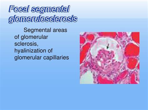Ppt Glomerulopathies Vs Glomerulonephritis Powerpoint Presentation