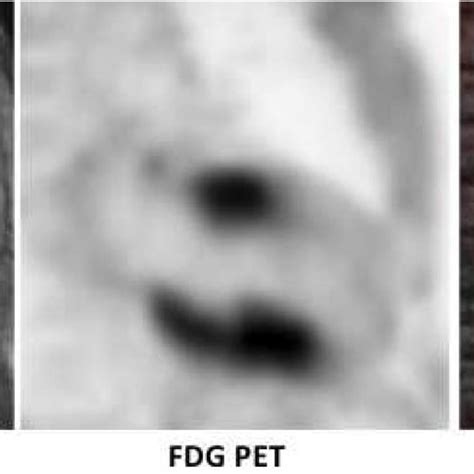 Viability Assessment With Hybrid Fdg Petmri A Fdg Petmri Viability