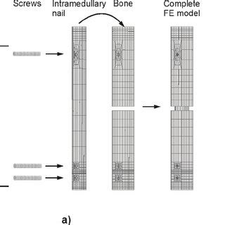 A Finite Element Model Of The Femur Comminuted Fracture Fixed By Download Scientific Diagram