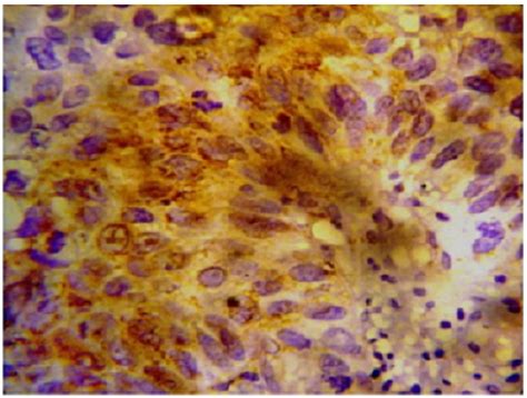 Hpv16 Immonostaining Was Seen Granular Cytoplasmic Perinuclear And