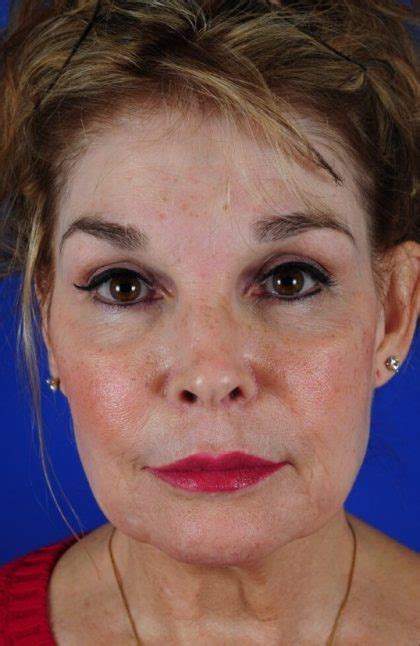 Patient 2324 Facial Fat Transfer Before And After Photos Englewood