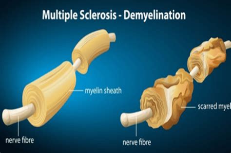 Multiple Sclerosis Facts Definition Symptoms Risk Factors