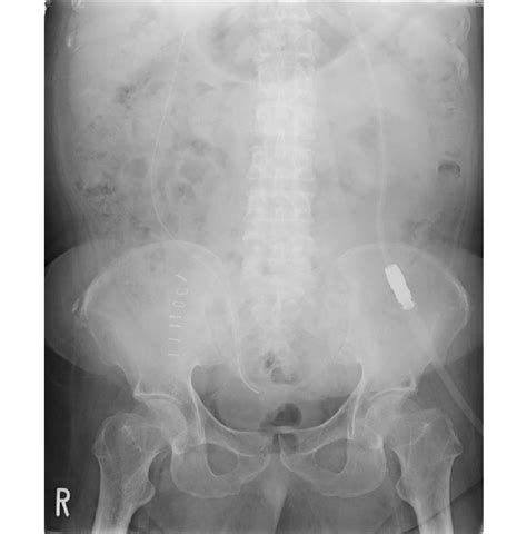 Abdomen X Ray After Insertion Of PD Catheter Download Scientific Diagram
