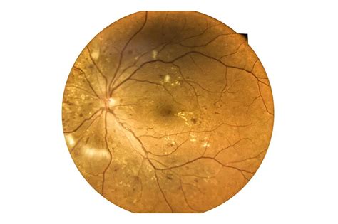 Diabetic Retinopathy Santa Monica Eye Group