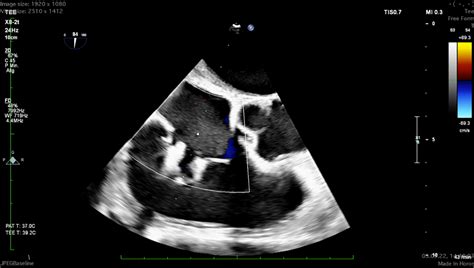 Higher Gradient After Tricuspid Teer Not Harmful At 1 Year Trivalve